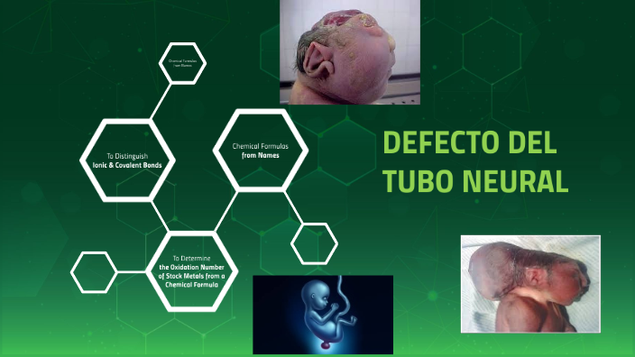 DEFECTO DEL TUBO NEURAL by Valentina hernandez on Prezi