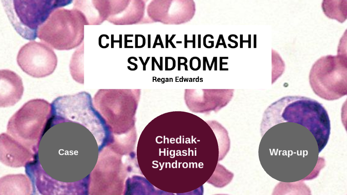 Chediak-Higashi Syndrome by Regan Edwards on Prezi