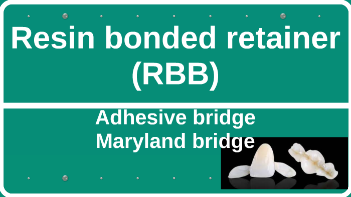 Resin bonded bridge (RBB) by Doaa Gamal on Prezi