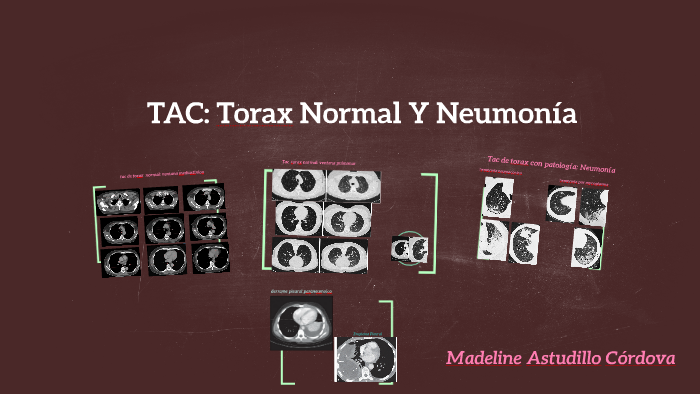 TAC: Torax Normal Y Neumonia by madeline astudillo on Prezi