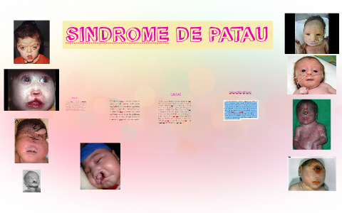 SINDROME DE PATAU by claudia bolaños on Prezi