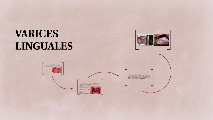 VARICES LINGUALES by Vianey Torres on Prezi