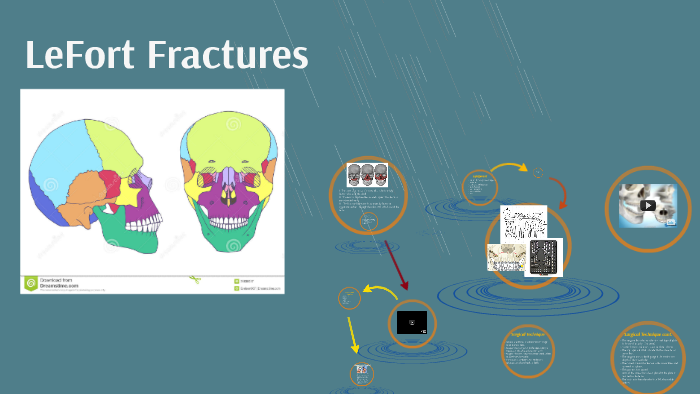 OPEN REDUCTION/INTERNAL FIXATION: MIDFACE FRACTURE by Gema Estello on Prezi