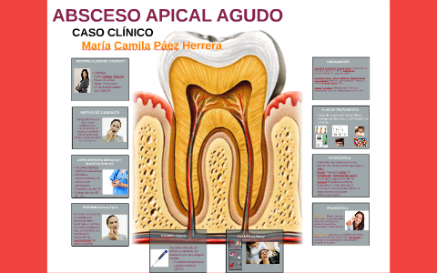 ABSCESO APICAL AGUDO by camila paez on Prezi