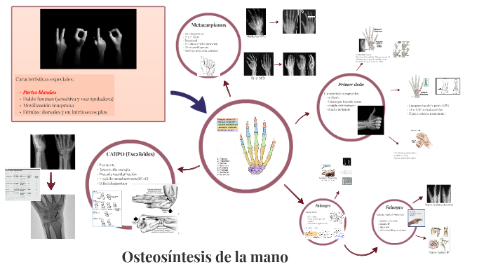 Osteosintesis mano CORUÑA by Maria Isabel Peinó Riobo on Prezi
