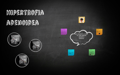 Hipertrofia Adenoidea by Diana Velasco on Prezi