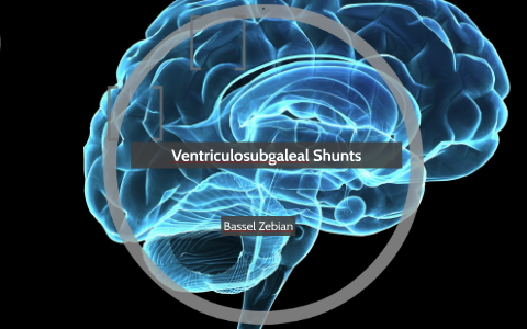 Ventriculosubgaleal Shunts by Wisam Faiadh on Prezi
