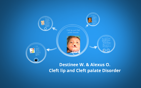 cleft lip and cleft palate disorder by destinee weaver on Prezi