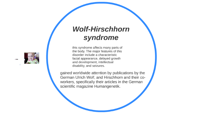 Wolf-hirschhorn syndrome by Joe venuti on Prezi