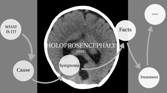 Holoprosencephaly by Johanna Mayfield on Prezi