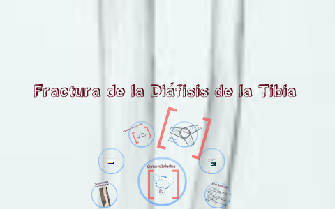 Fractura de la diáfisis de tibia by Nohemi Gómez on Prezi
