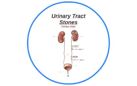 Urinary Tract Stones by Tom Lloyd on Prezi