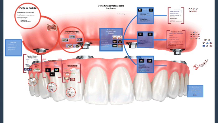 Protesis sobre implantes by tatiana rodriguez on Prezi