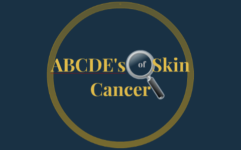 ABCDE's of Skin Cancer by Briana Martinez on Prezi