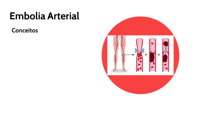 Embolia Arterial by anna martins on Prezi
