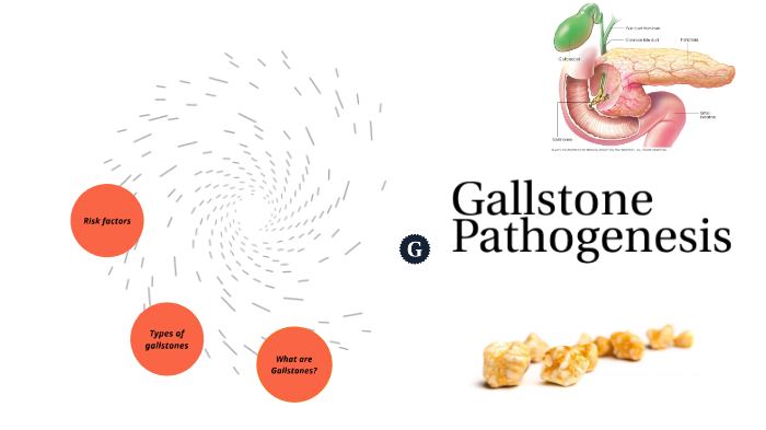 Gallstone Pathogenesis by Corvan Hall on Prezi
