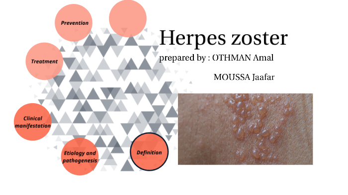 Herpes Zoster (shingles) by amal outhman on Prezi