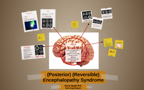 Posterior Reversible Encephalopathy Syndrome by Disha Spath on Prezi