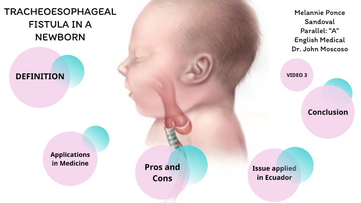 TRACHEOESOPHAGEAL FISTULA IN A NEWBORN by Melannie Ponce on Prezi