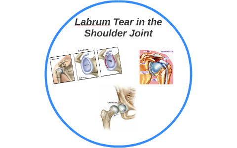 Labrum Tear in the Shoulder Joint by Kaitlyn Downing on Prezi