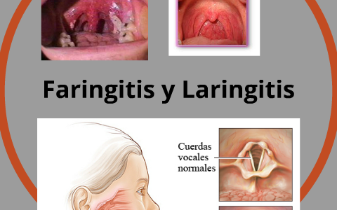 Faringitis y Laringitis by Dyna Landeta on Prezi