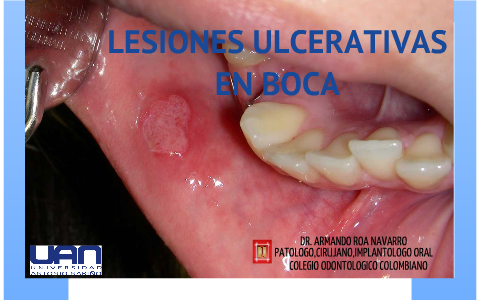 LESIONES ULCERATIVAS EN BOCA by Carlos Gomez on Prezi