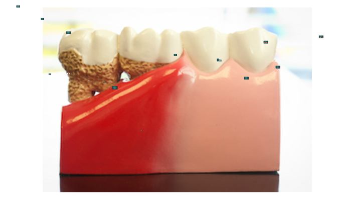 Development of a Classification System for Periodontal Diseases ...