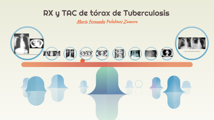 RX y TAC de torax de Tuberculosis by fernanda paladines on Prezi