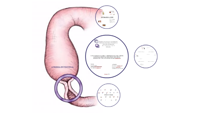 Atresia Intestinal by ISABEL HERNANDEZ on Prezi