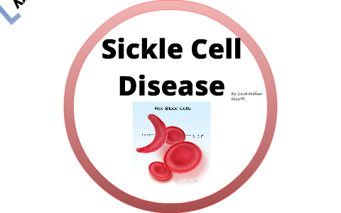 Sickle Cell Disease by Jacob Haffner on Prezi
