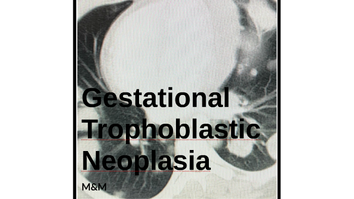 Gestational Trophoblastic Neoplasia by flear vaknin on Prezi