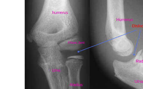 AP and Lateral elbow x-ray Image by Aardvark Pannick on Prezi