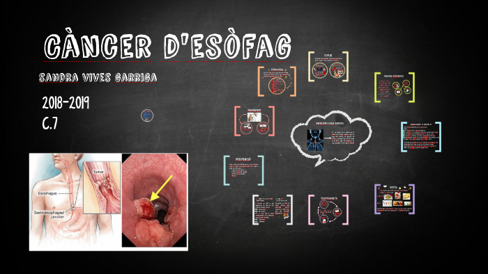 càncer d'esofag by Sandra Vives on Prezi