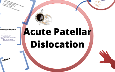Acute Patellar Dislocation by emily santacroce on Prezi