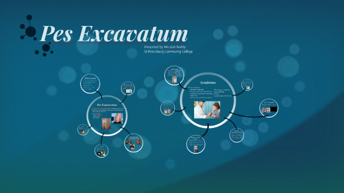 Pes Excavatum by on Prezi