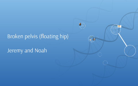 Broken pelvis (floating hip) by Jeremy Biggerstaff on Prezi