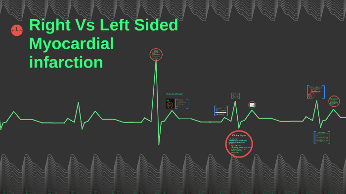 Right Vs Left Sided Myocardial infarction by Bobbi Lowie on Prezi