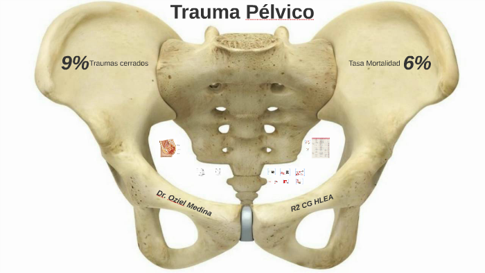 Trauma Pelvico by Oziel Medina on Prezi