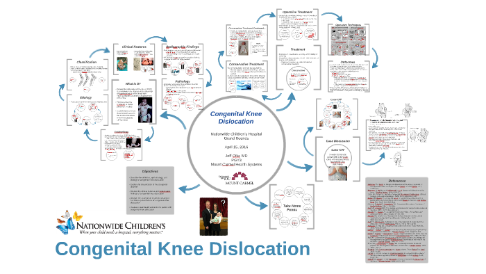 Congenital Knee Dislocation by Jeff Otte