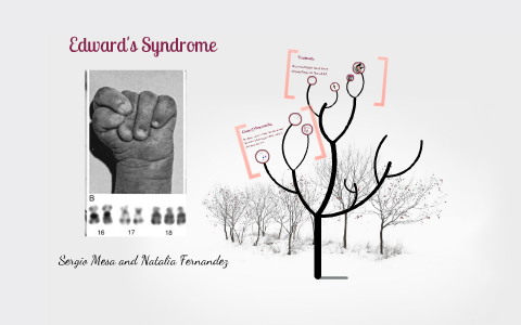 Edward´s Syndrome\ Trisomy 18 by Natalia Fernandez on Prezi