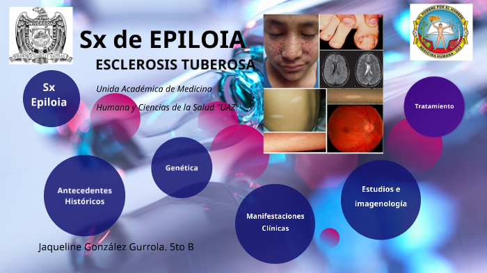 Epiloia ( Esclerosis Tuberosa) by Jaqueline González Gurrola on Prezi