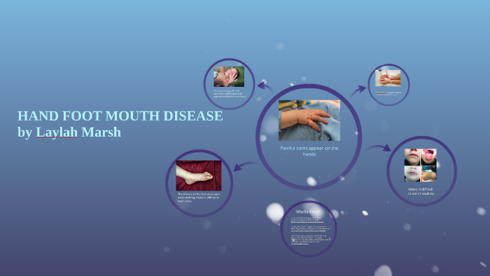 HAND FOOT MOUTH DISEASE by Laylah Marsh on Prezi
