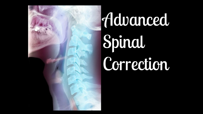 Advanced Spinal Correction by nschiro nschiro on Prezi