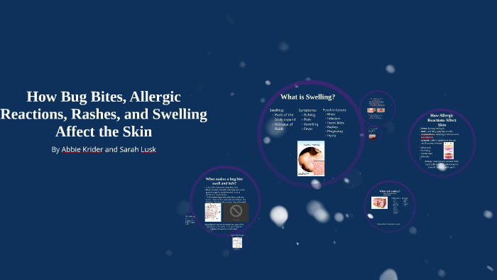 Bug Bites Allergic Reactions Rashes And Swelling By Abbie Sarah On Prezi