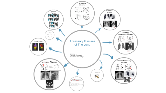 Accessory Fissures of the Lung by Lawrence Lo on Prezi