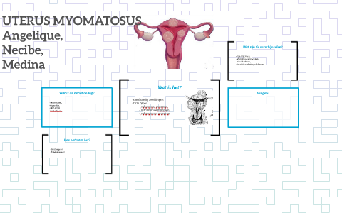 UTERUS MYOMATOSUS by on Prezi