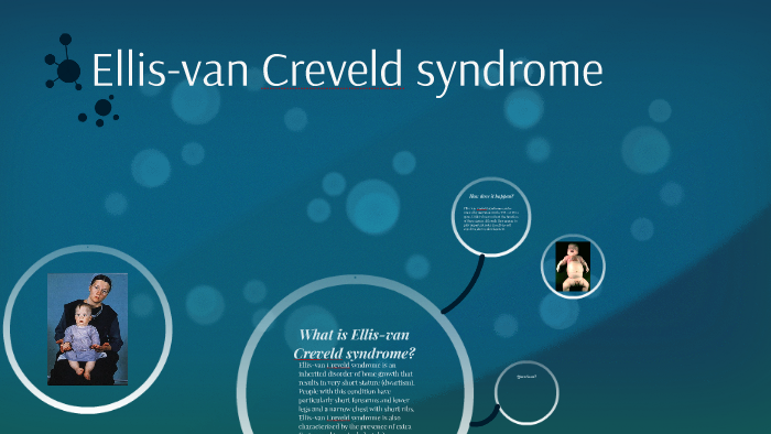 Ellis-van Creveld syndrome by emily childs on Prezi
