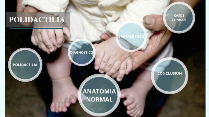 polidactilia by CECILIA LOPEZ on Prezi