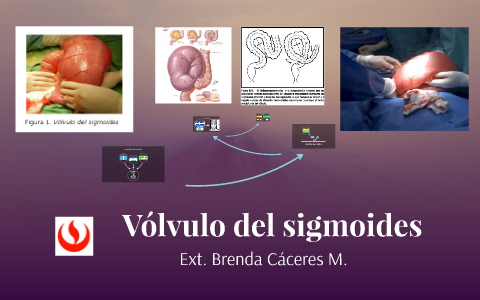 Vólvulo del sigmoides by Brenda Caceres Mejia on Prezi