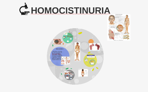 HOMOCISTINURIA by aylin leiva on Prezi